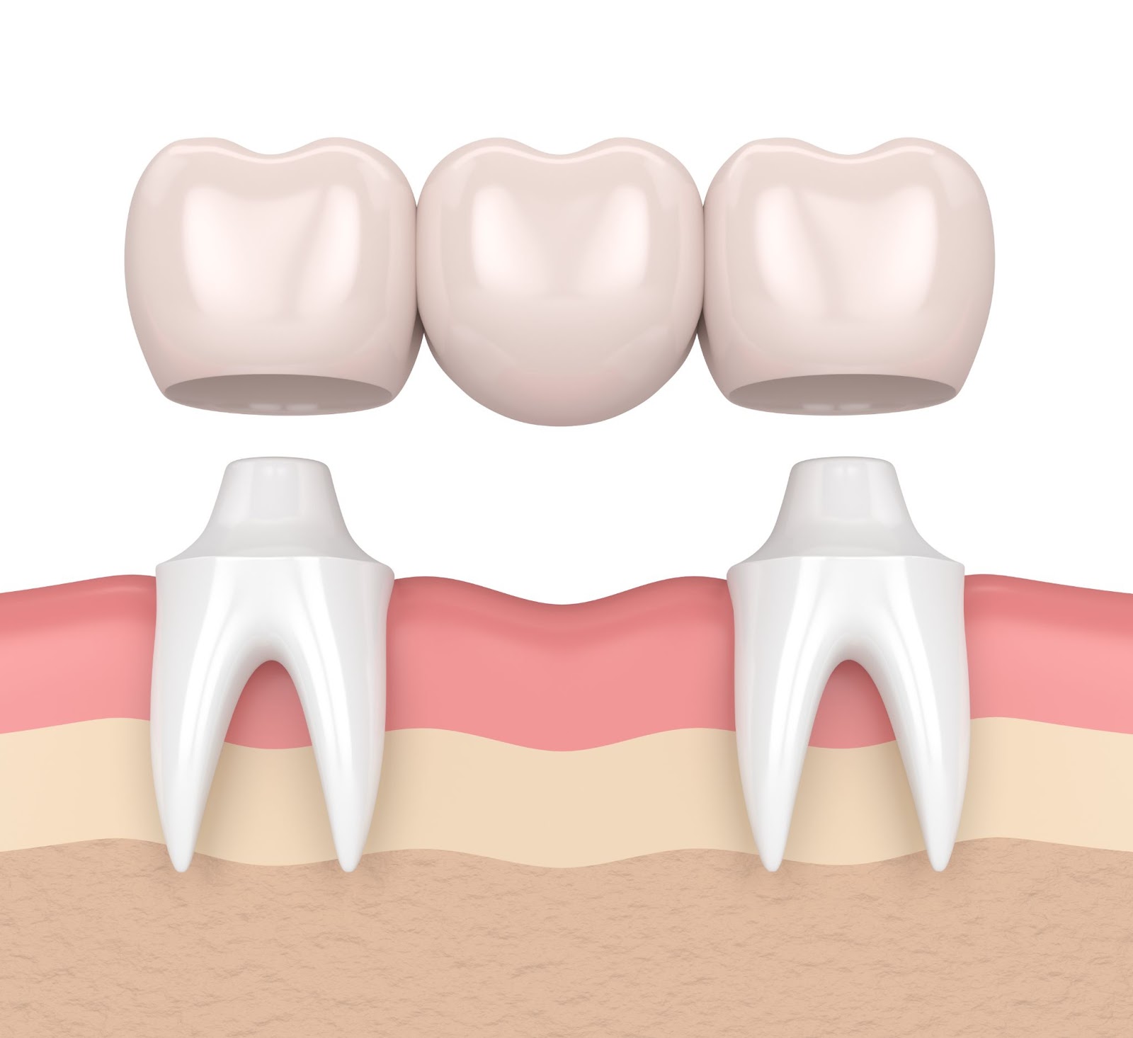 Dental Crowns vs Bridges: Find the Right Choice