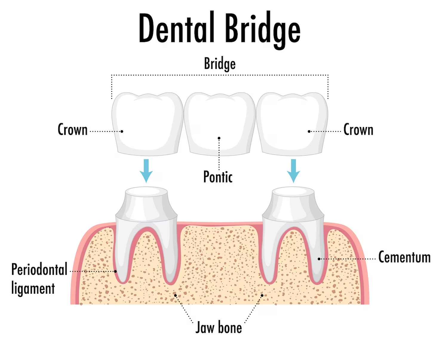 Dental Bridges Demystified: Benefits, Costs & Why They’re a Smart Choice
